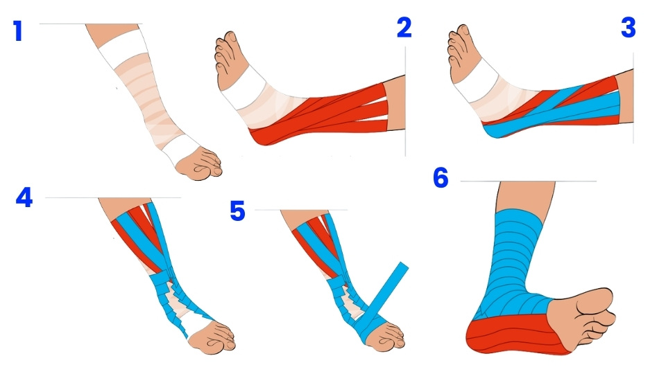 Strapping cheville : comprendre comment strapper