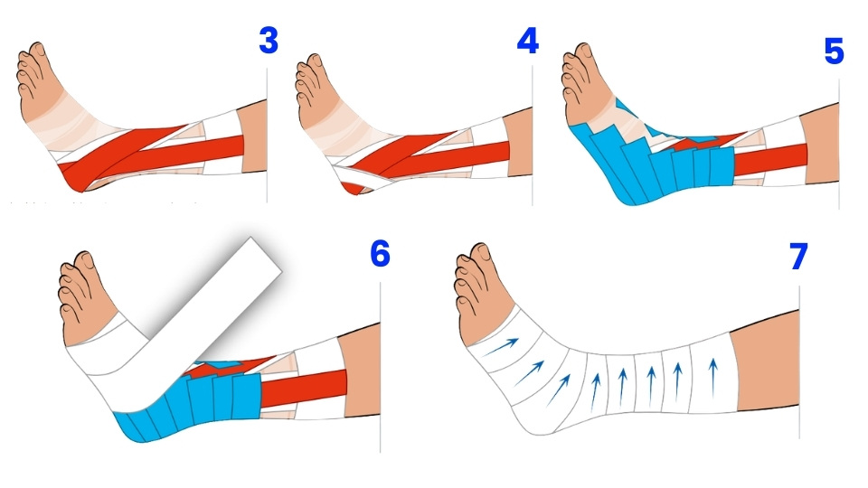 Strapping cheville : comprendre comment strapper