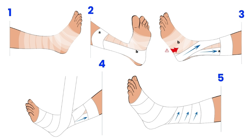 Strapping cheville : comprendre comment strapper